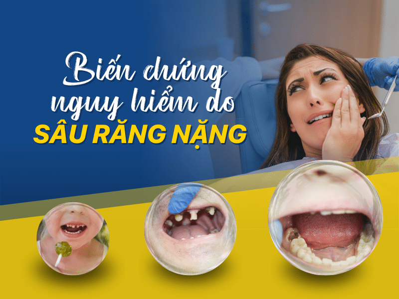 Biến chứng nguy hiểm do sâu răng nặng