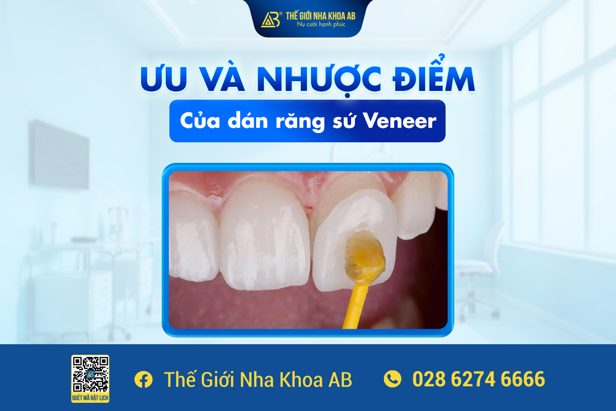 ƯU VÀ NHƯỢC ĐIỂM CỦA DÁN RĂNG SỨ VENEER