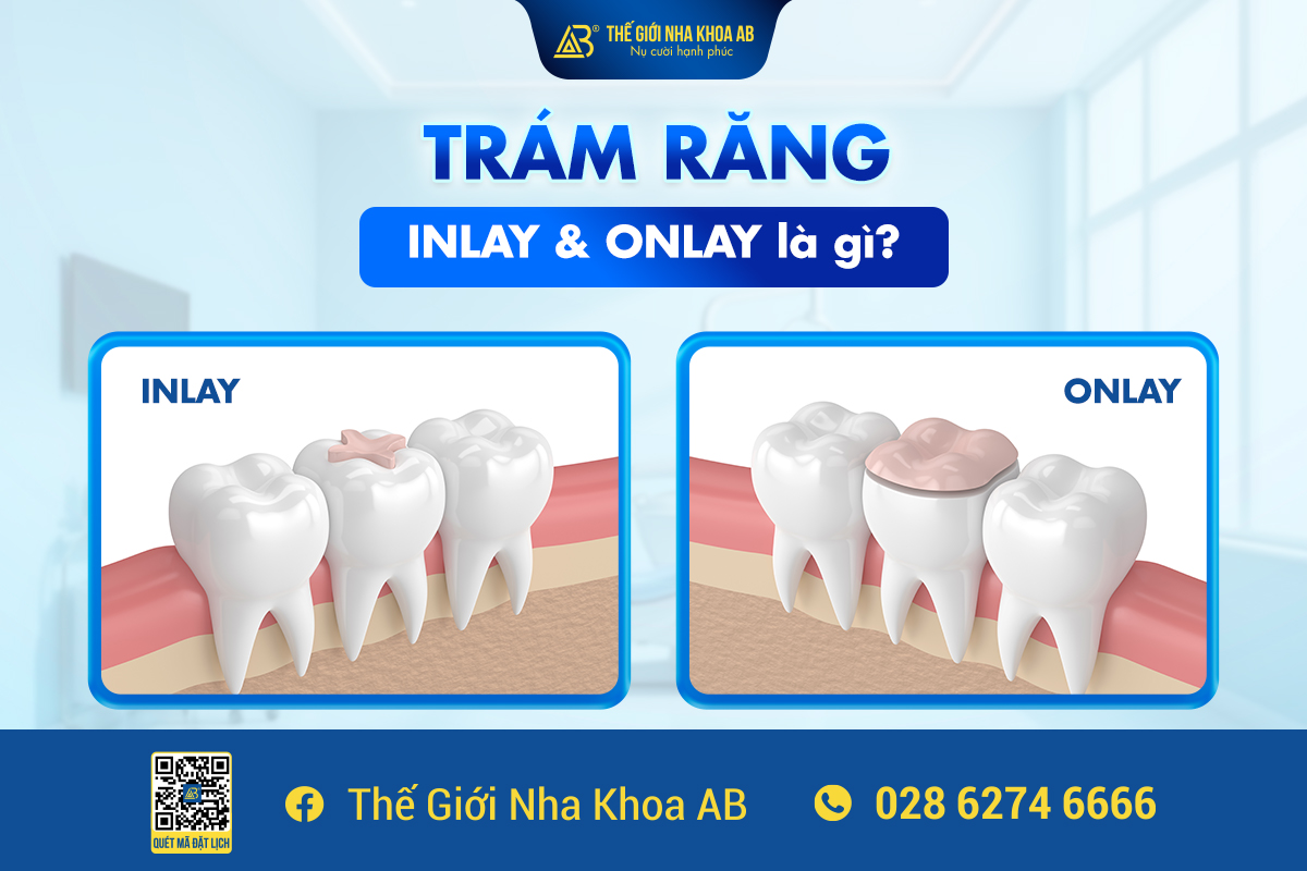 TRÁM RĂNG INLAY VÀ ONLAY LÀ GÌ? - Thế giới nha khoa AB